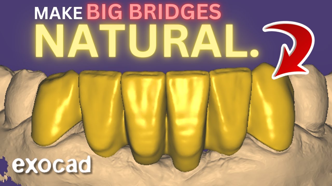 ANTERIOR Bridge EXOCAD. 2024 Tutorial - YouTube