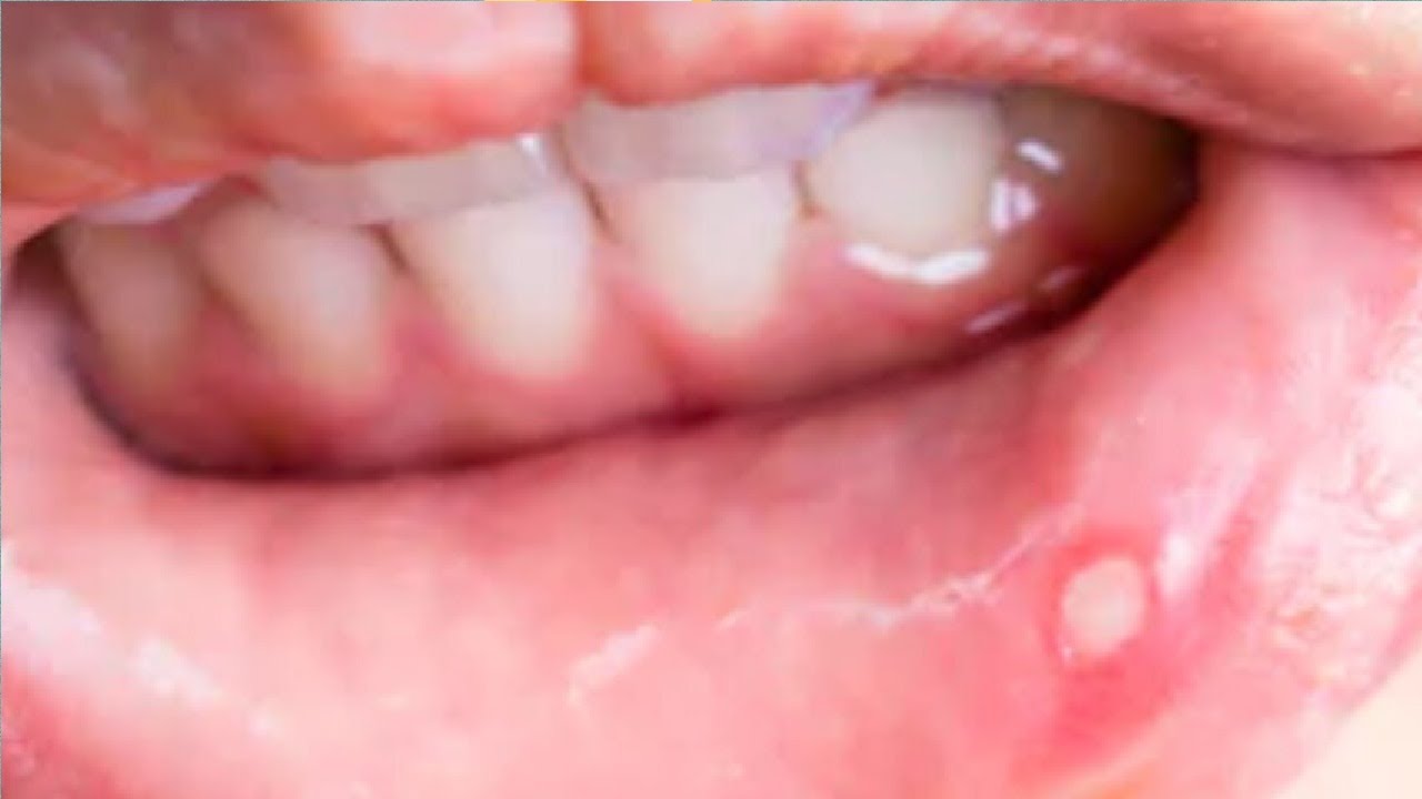 how to get rid of canker sores on roof of mouth - YouTube