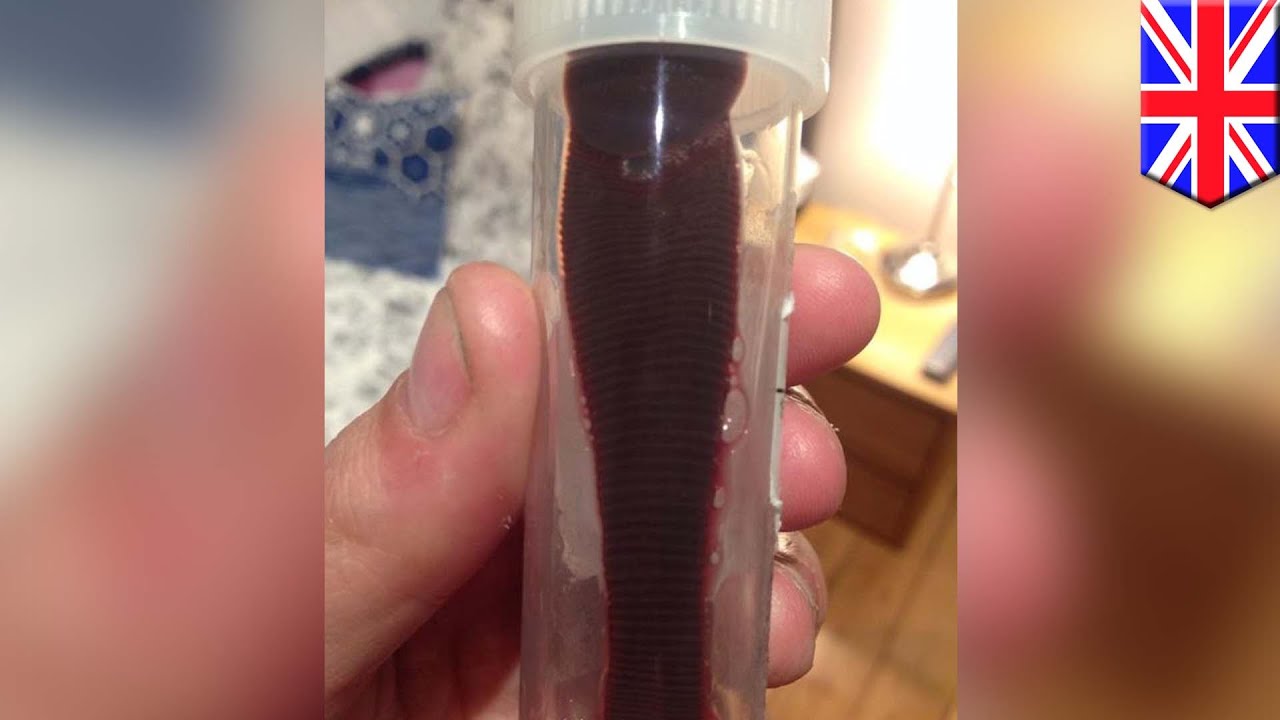 Disgusting! 3-inch-long leech spent month up the nose of British ...