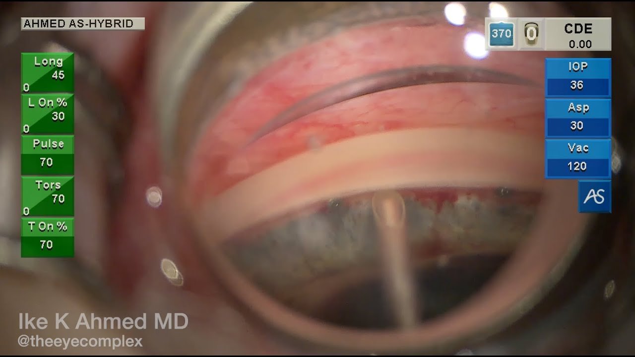 Phaco iStent Goniosynechialysis and Goniotomy in Angle Closure Glaucoma - YouTube