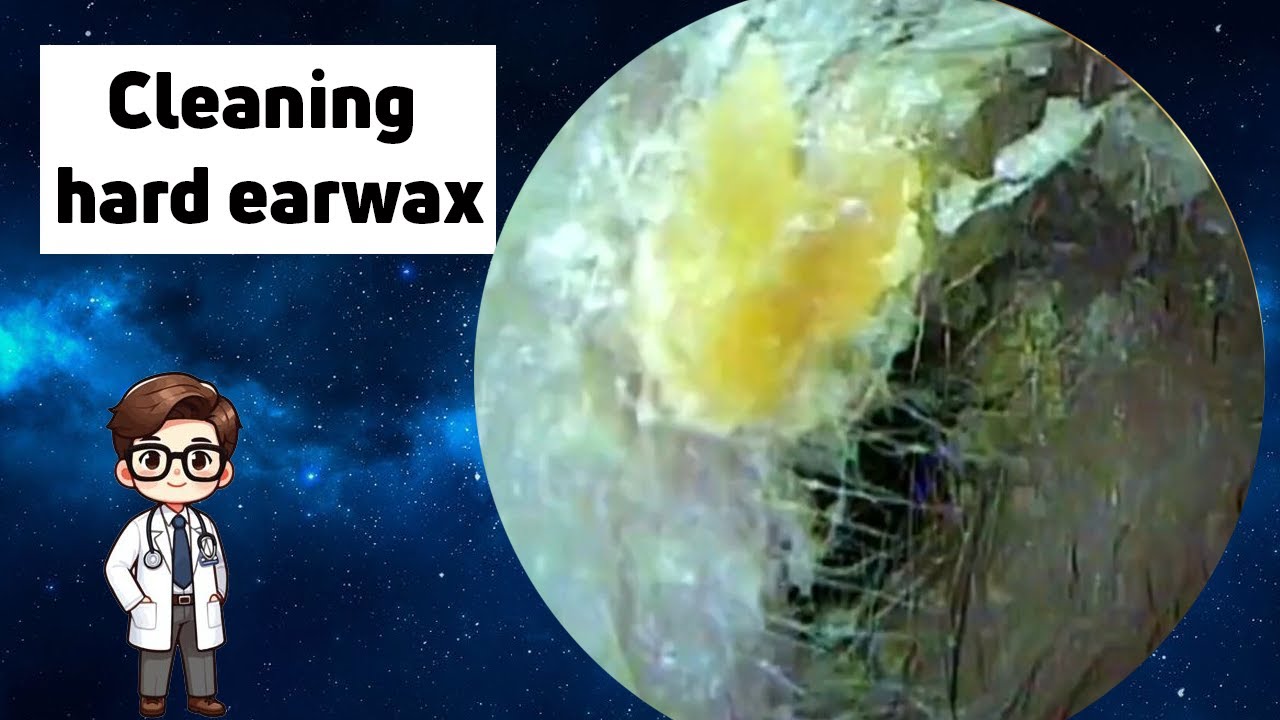 Deepest Ear Cleaning Ever - deep ear cleaning - ASMR ear cleaning - YouTube