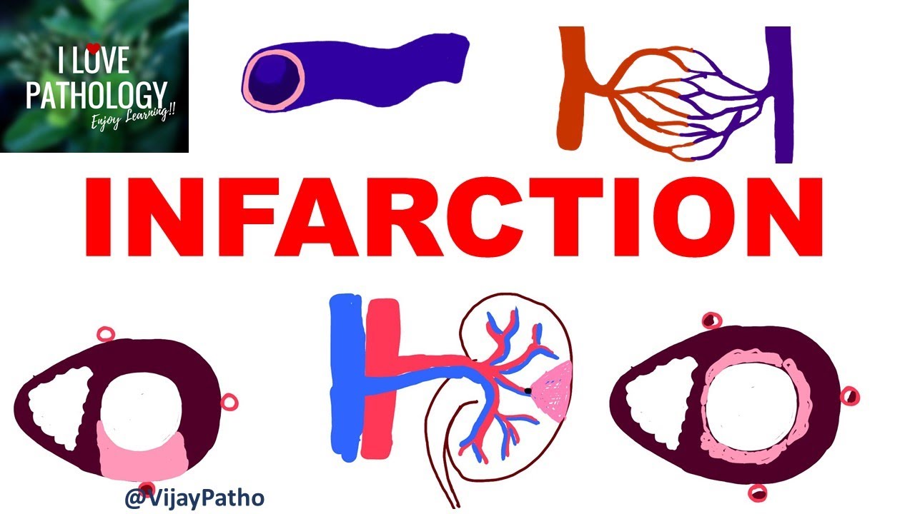 INFARCTION: Causes, Types, Morphology - YouTube