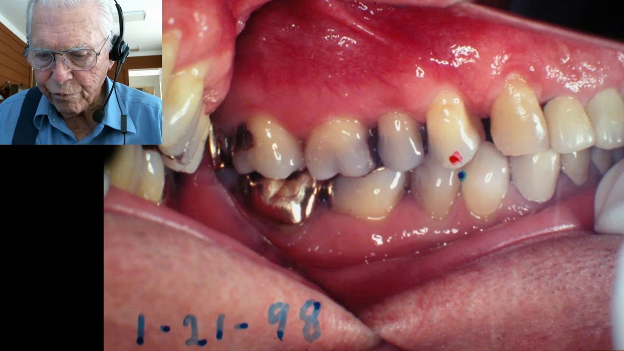 The real cause of most TMJ pain- Part 2 (Case Examples) - YouTube