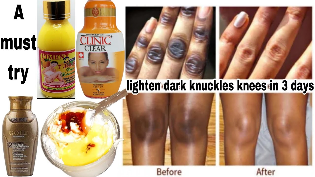 Use nivea cream/ Lighting Dark knuckles & knees elbows in 3 Days dark ...