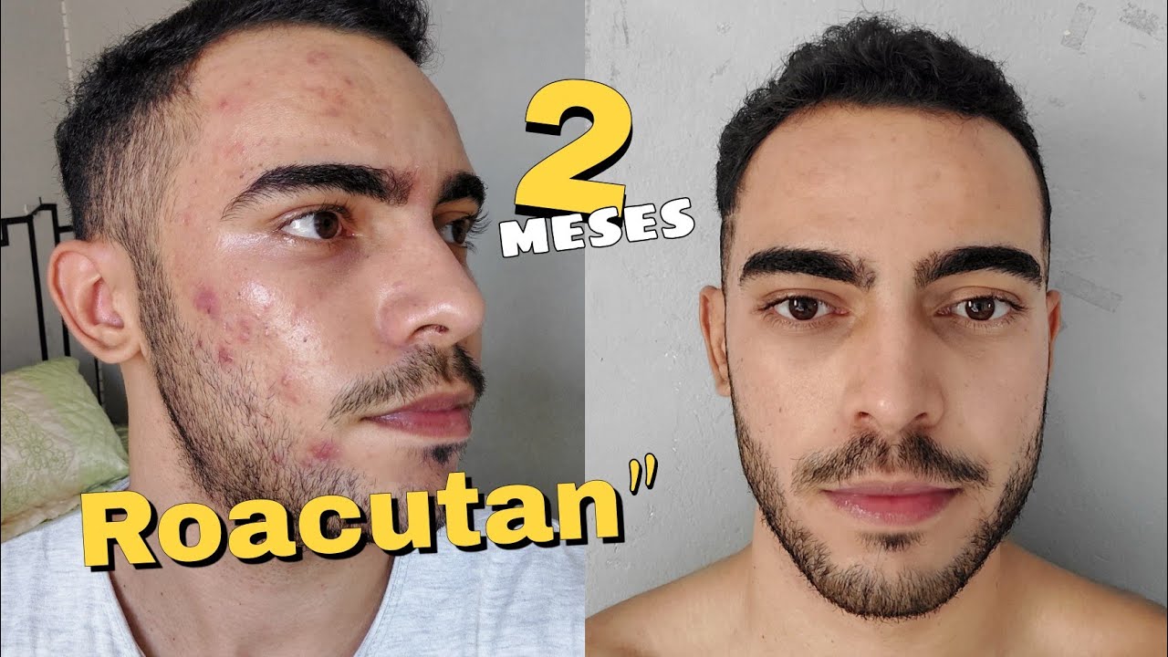EVOLUÇÃO de 2 meses usando roacutan + Prós e Contras. 💊 - YouTube