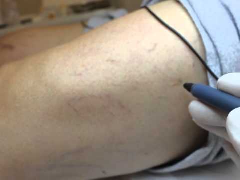 KILCAL VARİSLERDE TERMOKOAGÜLASYON TEDAVİSİ