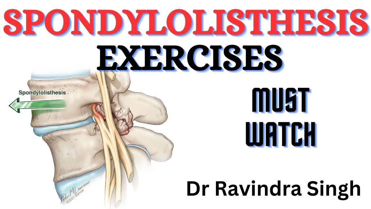 Spondylolisthesis Exercises & Stretches for Back Pain - Dr Rao - YouTube