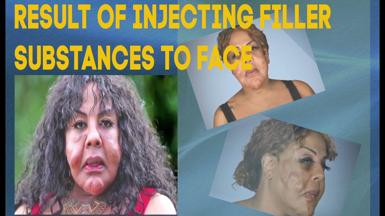 Botched Body: Terrifying Results of Injecting Filler Substances to Face ...