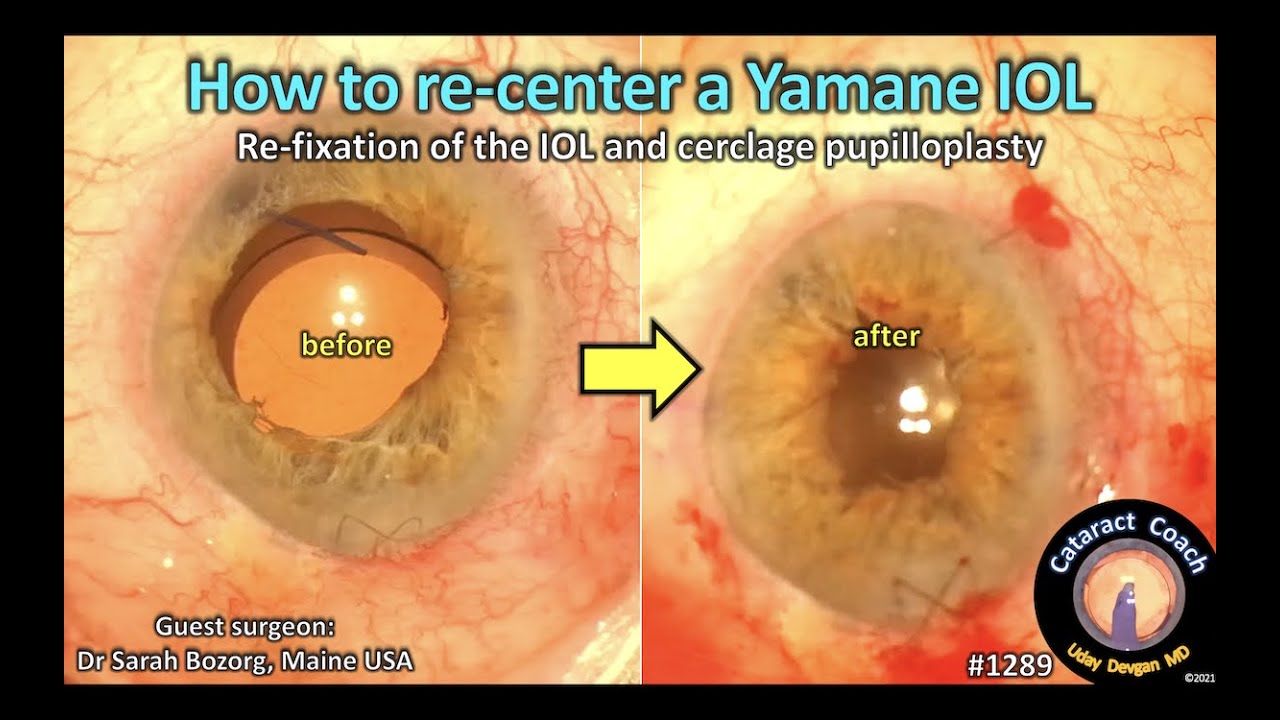 CataractCoach 1289: how to re-center yamane-style scleral fixated IOL ...
