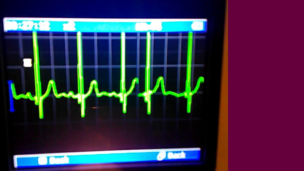 Heartbeat livestream (With ECG and audio) - YouTube