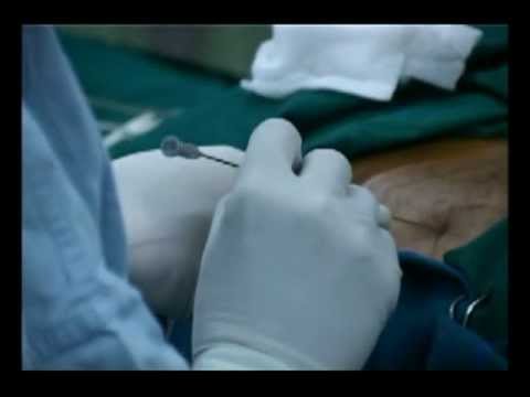 sciatica disc surgery - YouTube