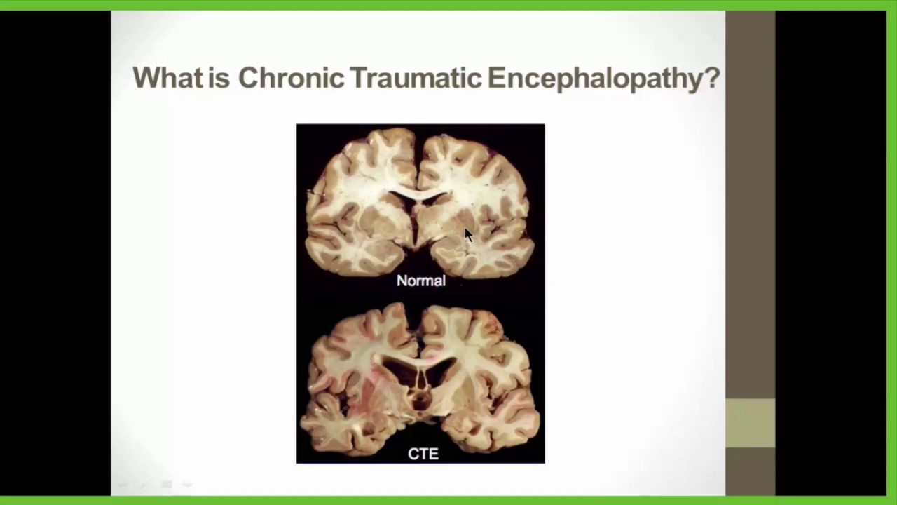 #e123 Preview: Executive Function Treatment - In The Face Of CTE - YouTube