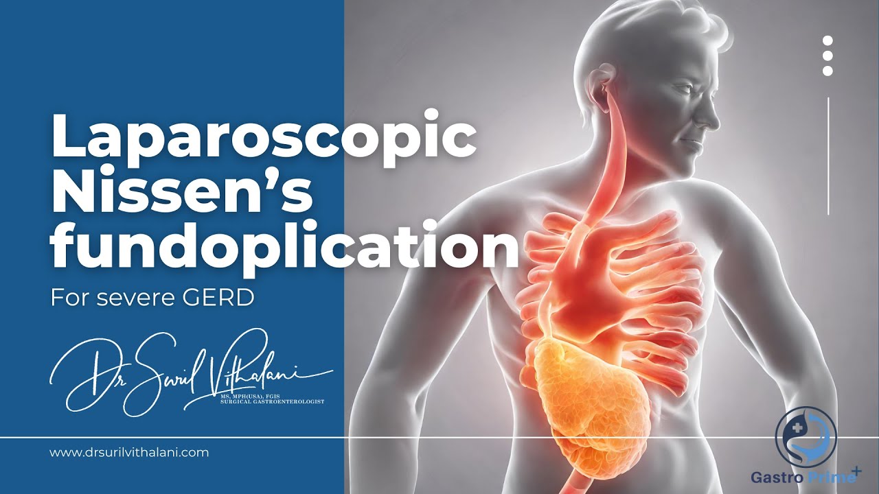 Laparoscopic Nissen's fundoplication for GERD | Unedited | Dr. Suril ...