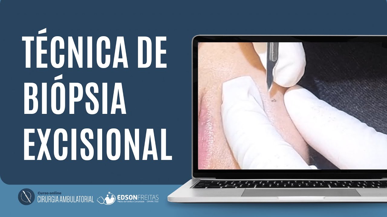 Biópsia Excisional - Curso Online de Cirurgia Ambulatorial - YouTube
