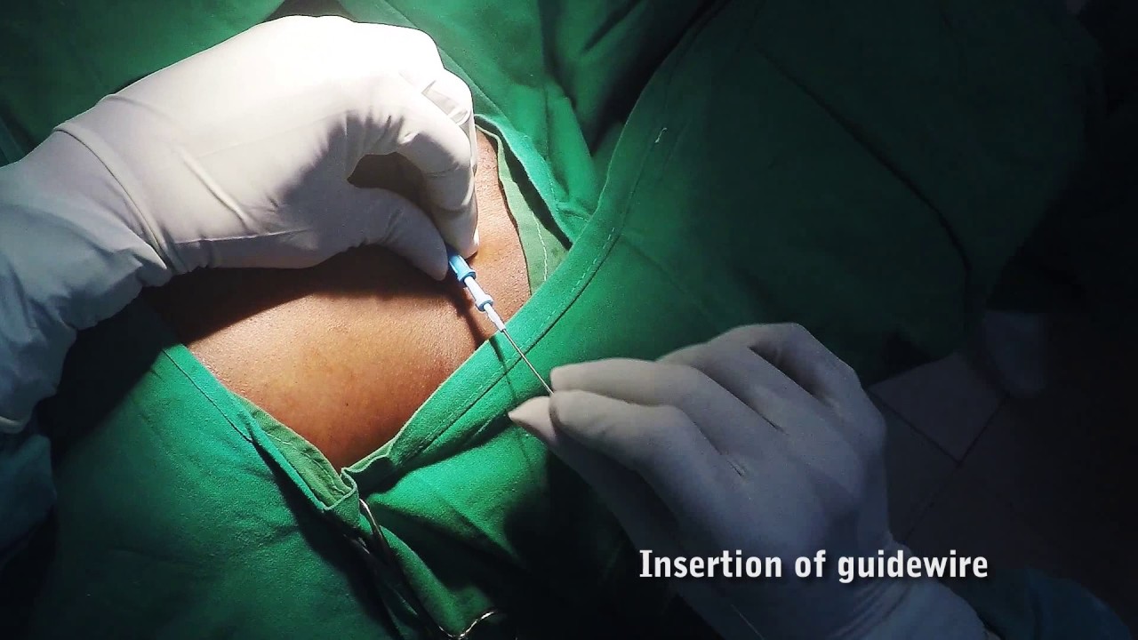 Insertion of First Guidewire - YouTube