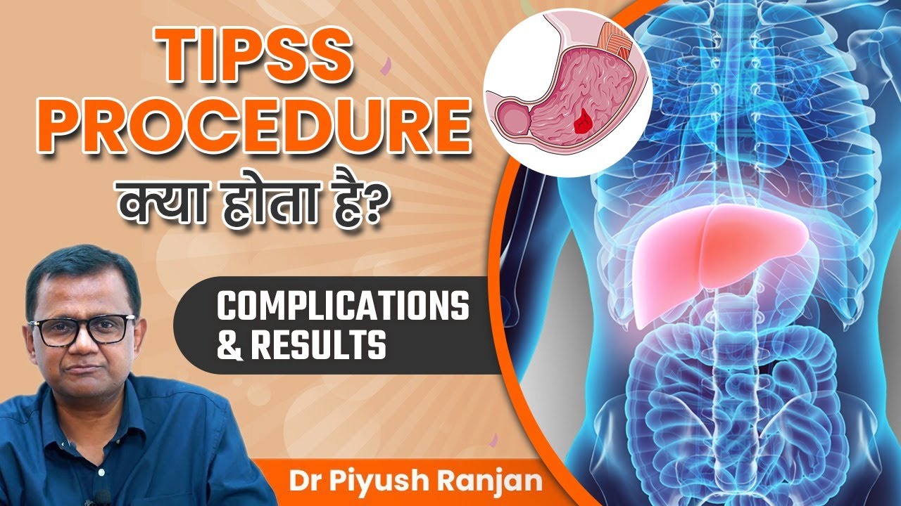 TIPSS Procedure क्या होता है? | TIPS Complications and Results? | Dr ...