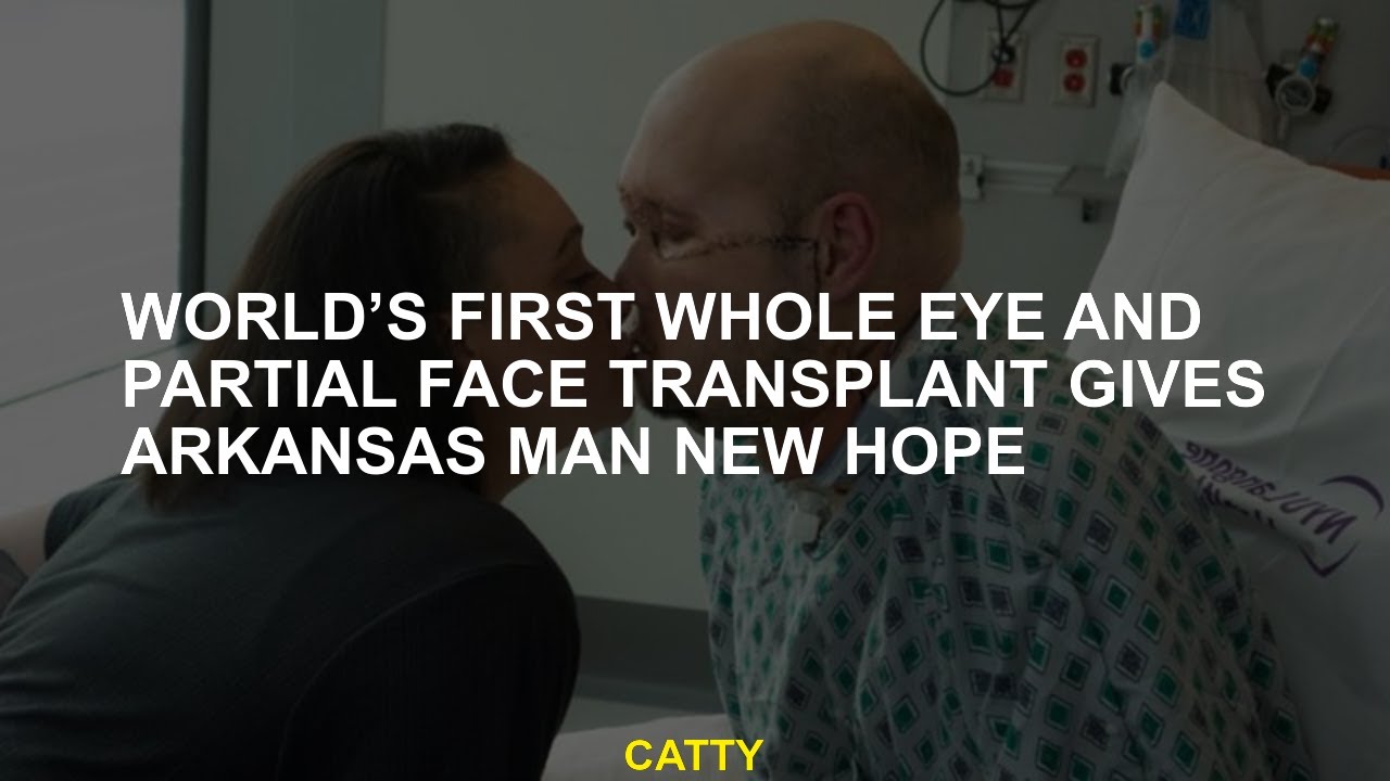 World’s first whole eye and partial face transplant gives Arkansas man ...