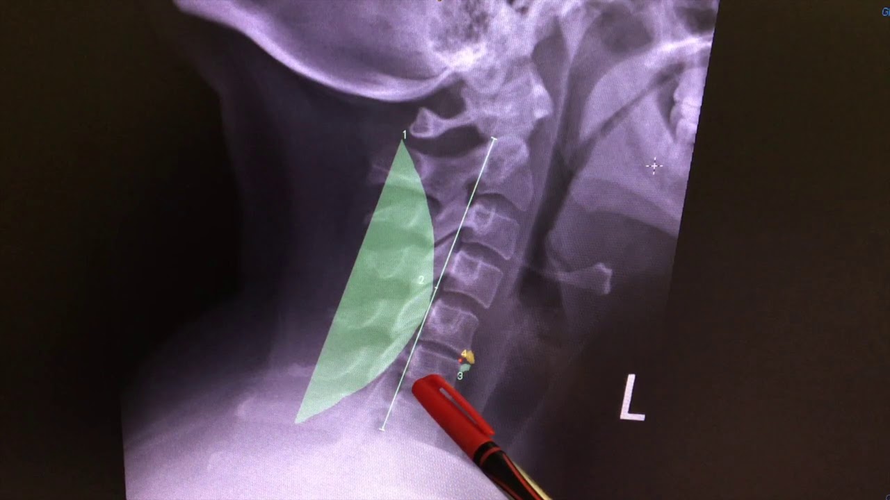 Cervical (Neck) X-Ray: Degenerative Disc, Bone Spurs and Neural ...
