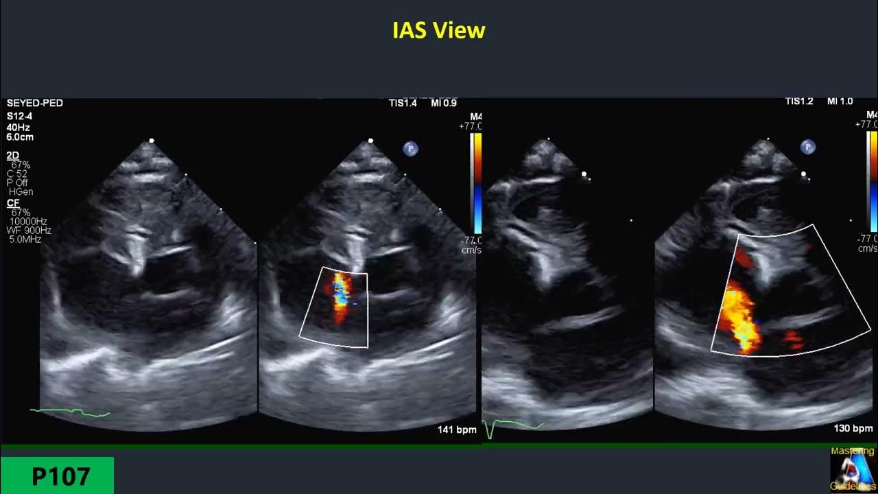 Pediatric Echo Part 3 Psax Rvit Rvot Views Protocol Youtube