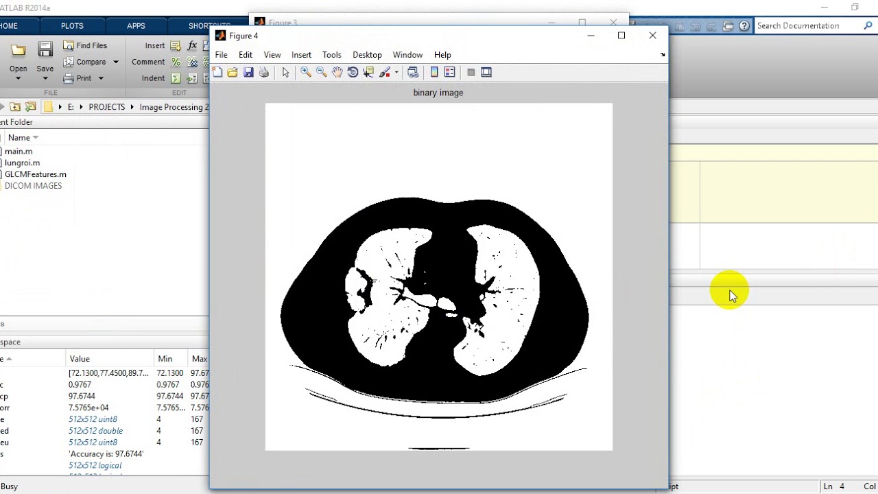 Lung Cancer Detection And Classification Using Matlab Source Code Youtube