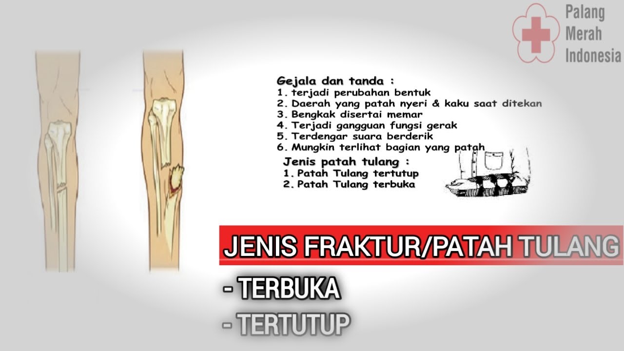 Cara mengatasi patah tulang ( Fraktur)terbuka dan tertutup ...
