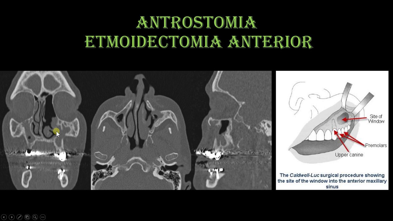 Antrostomia - YouTube