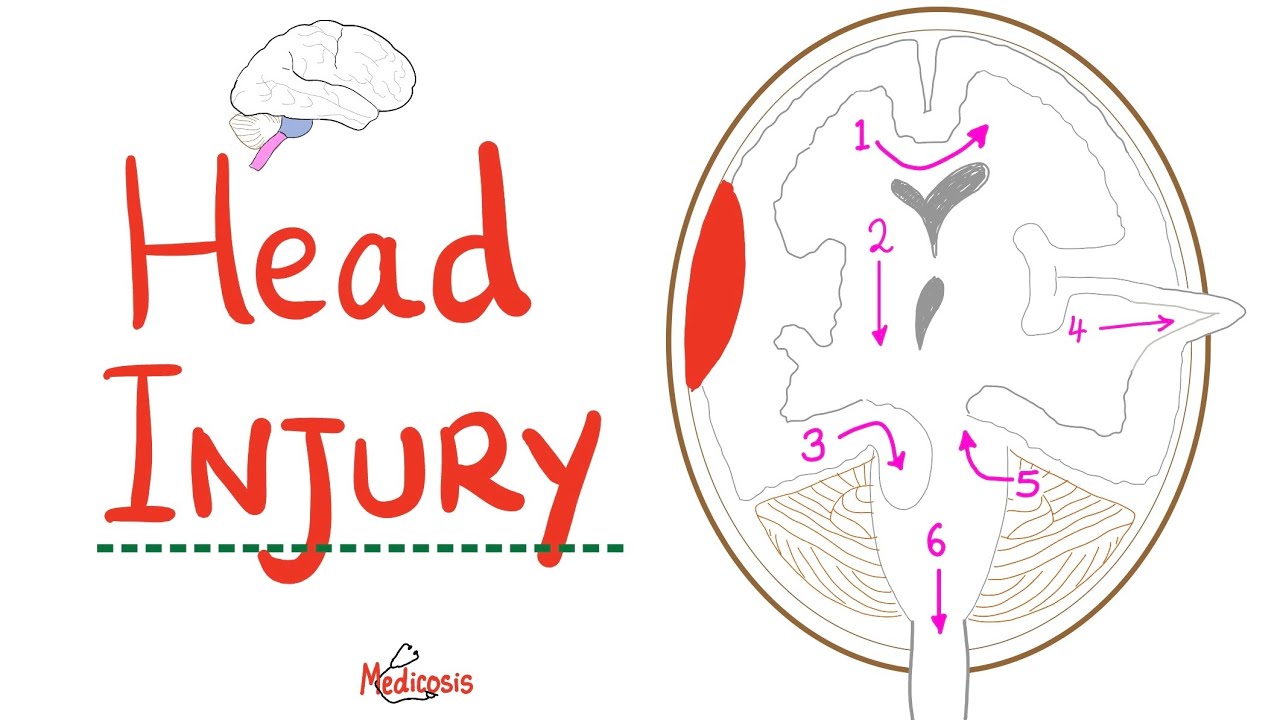 Brain Trauma - Traumatic Brain Injury (TBI) - Fracture, Contusion ...