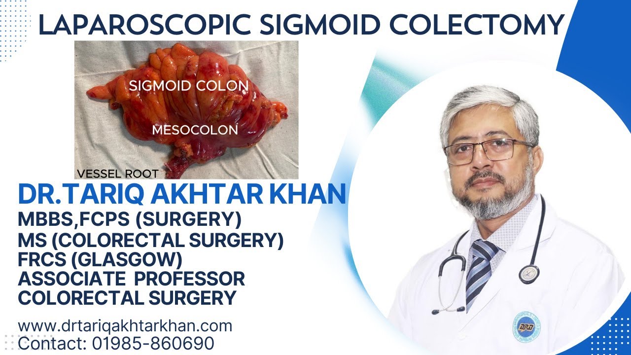 Laparoscopic sigmoid colectomy for stage 3 colon cancer by master ...