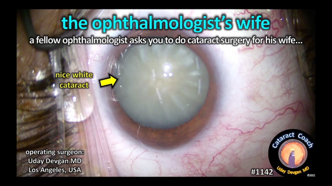 CataractCoach 1142: white cataract in the ophthalmologist's wife - YouTube