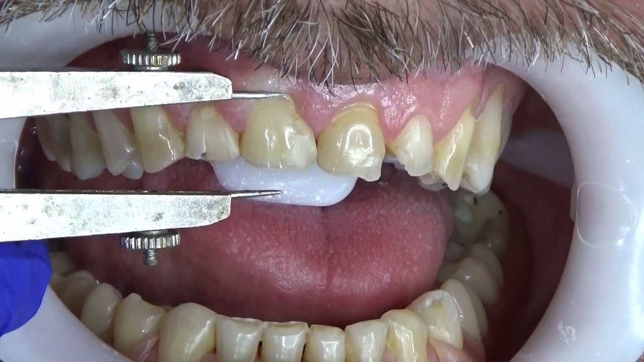🔥PASSO A PASSO PLANEJAMENTO EM BOCA e EXECUÇÃO ETAPAS DE RECONSTRUÇÃO ...