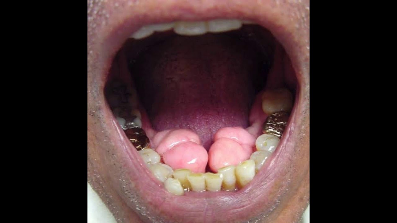 Torus palatinus/mandibularis-SN-English - YouTube