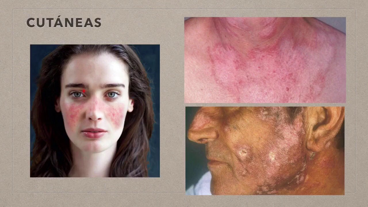 Lupus Eritematoso Sistémico Youtube