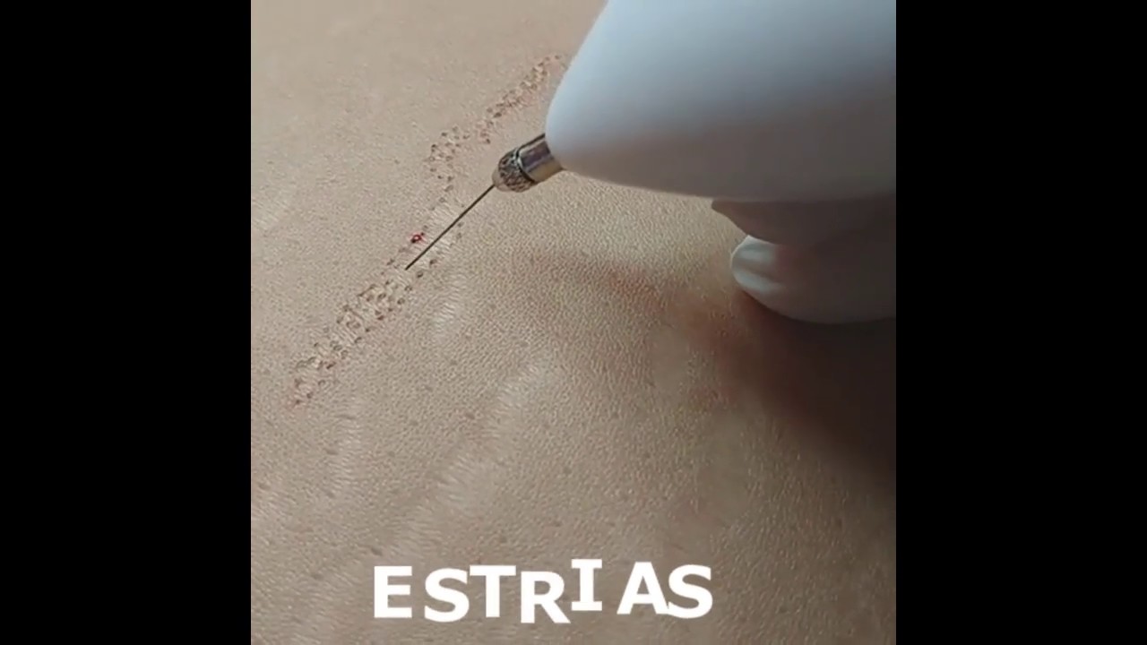 Tratamento de Estrias com Caneta Laser Plasma - YouTube