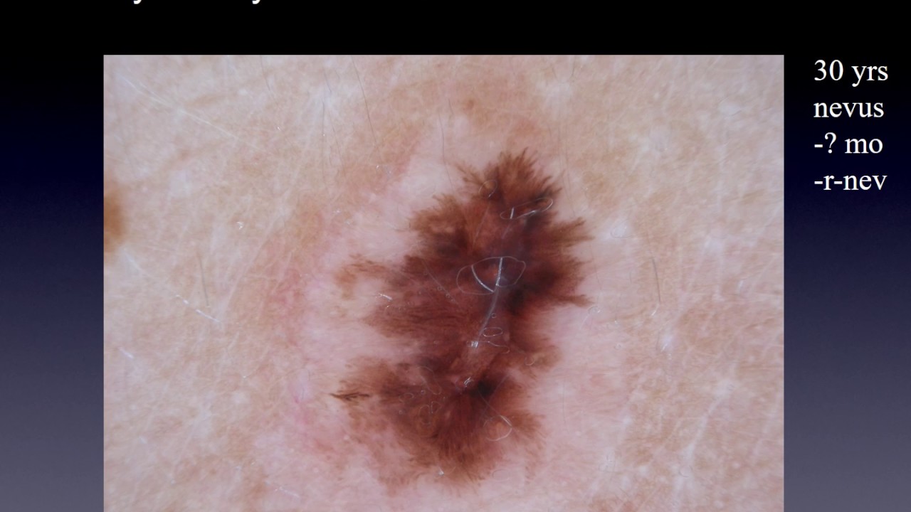 Recurrent nevus or melanoma - Dr. Andreas Blum - YouTube