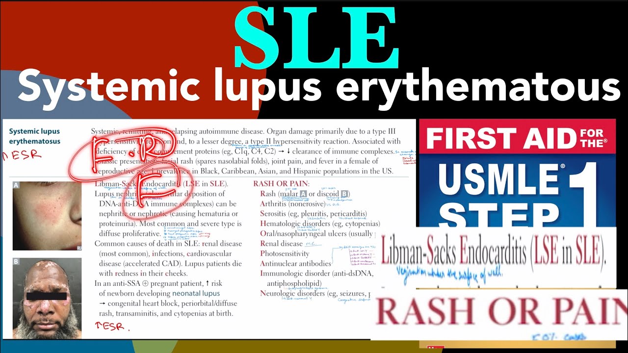 Systemic lupus erythematous (SLE) in Hindi/Urdu by first aid for USMLE ...