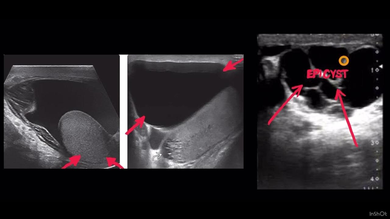 Tkr Dds 05 Hydrocele Vs Epididymal Cyst🚦 Youtube