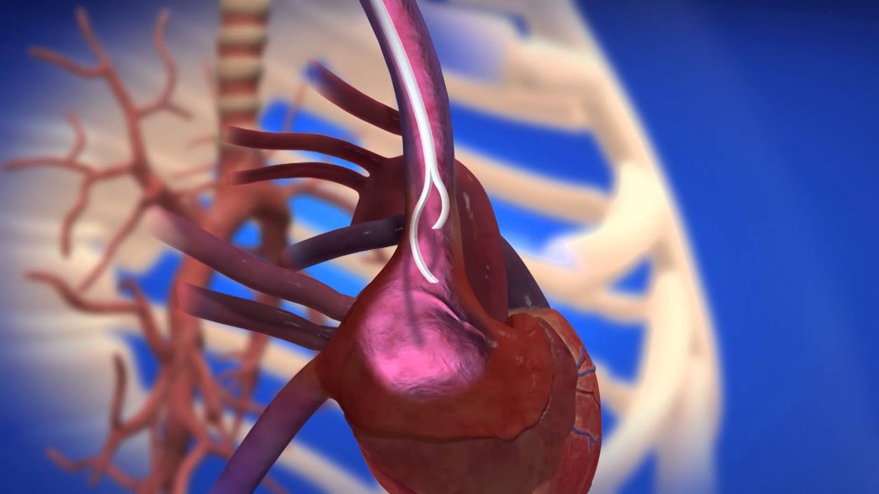 CentrosFLO® Long-Term Hemodialysis Catheter - YouTube