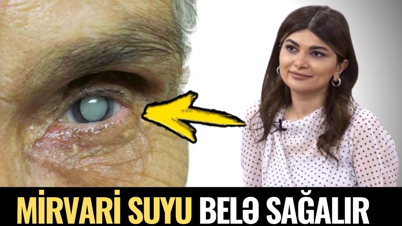 Həkim Mirvari Suyunu Sağaltdı - Kataraktının Müalicəsi - YouTube