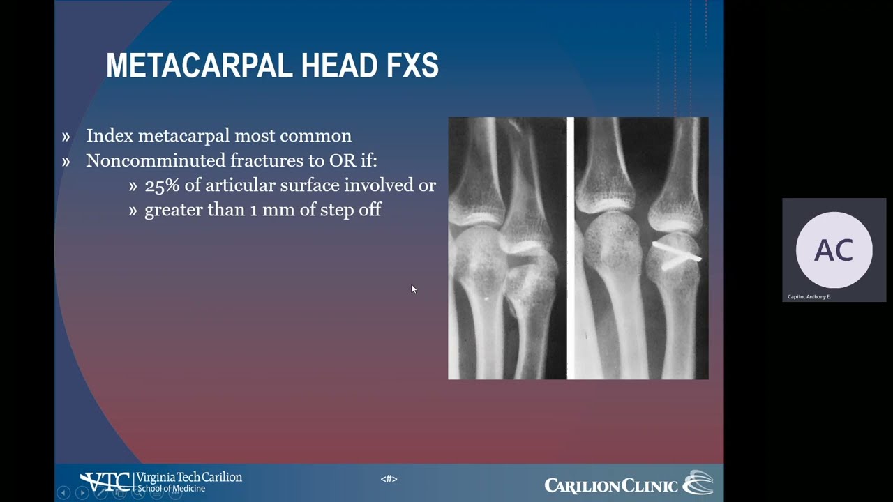Metacarpal Head Fracture