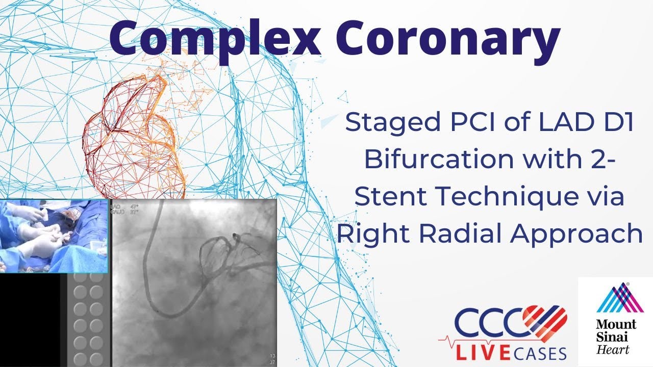 Staged PCI of LAD D1 Bifurcation w 2-Stent Technique via Right Radial ...