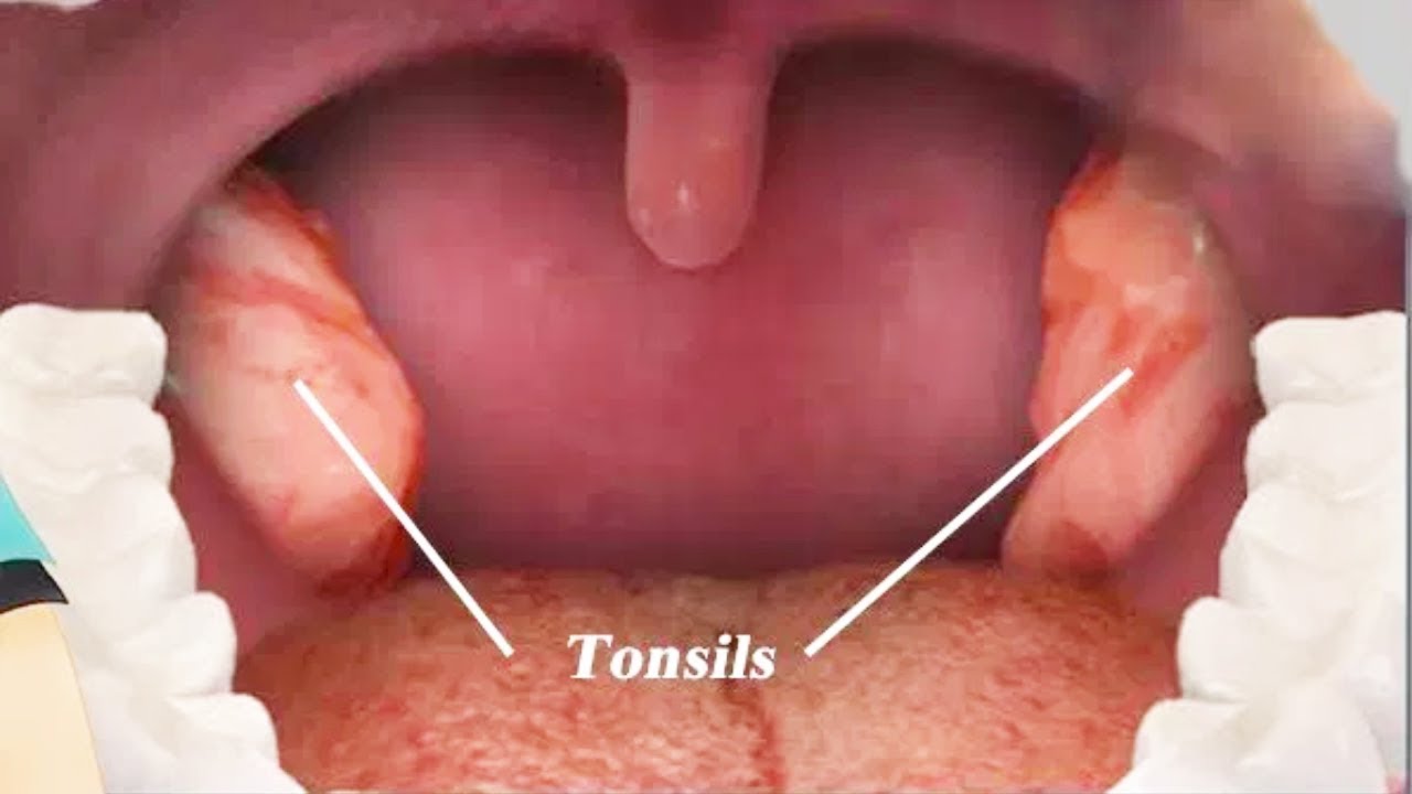 Tonsil Cancer Ke Lakshan In Hindi Rima1 tonsil-cancer-ke-lakshan-in-hindi-rima1