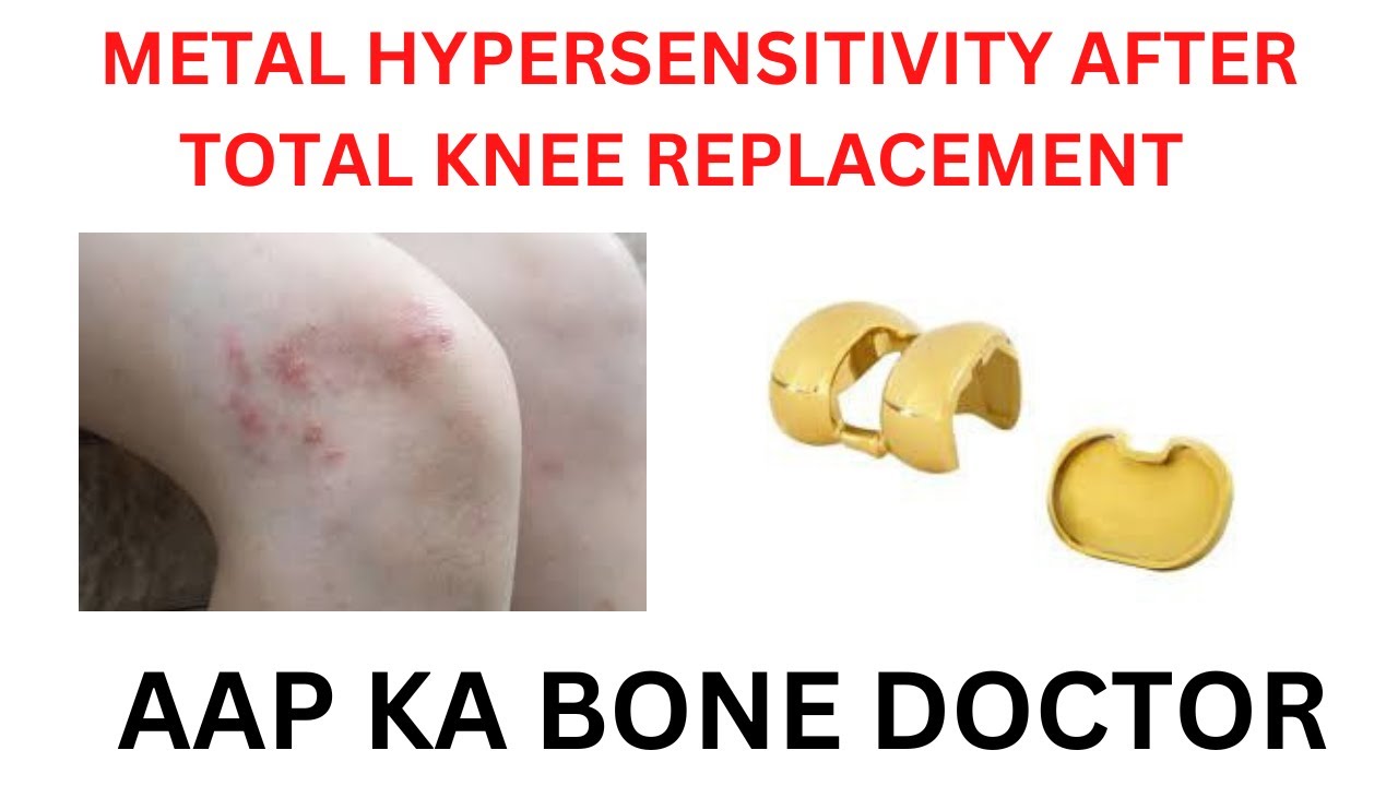 METAL HYPERSENSITIVITY AFTER TOTAL KNEE REPLACEMENT - EPISODE 25 - YouTube