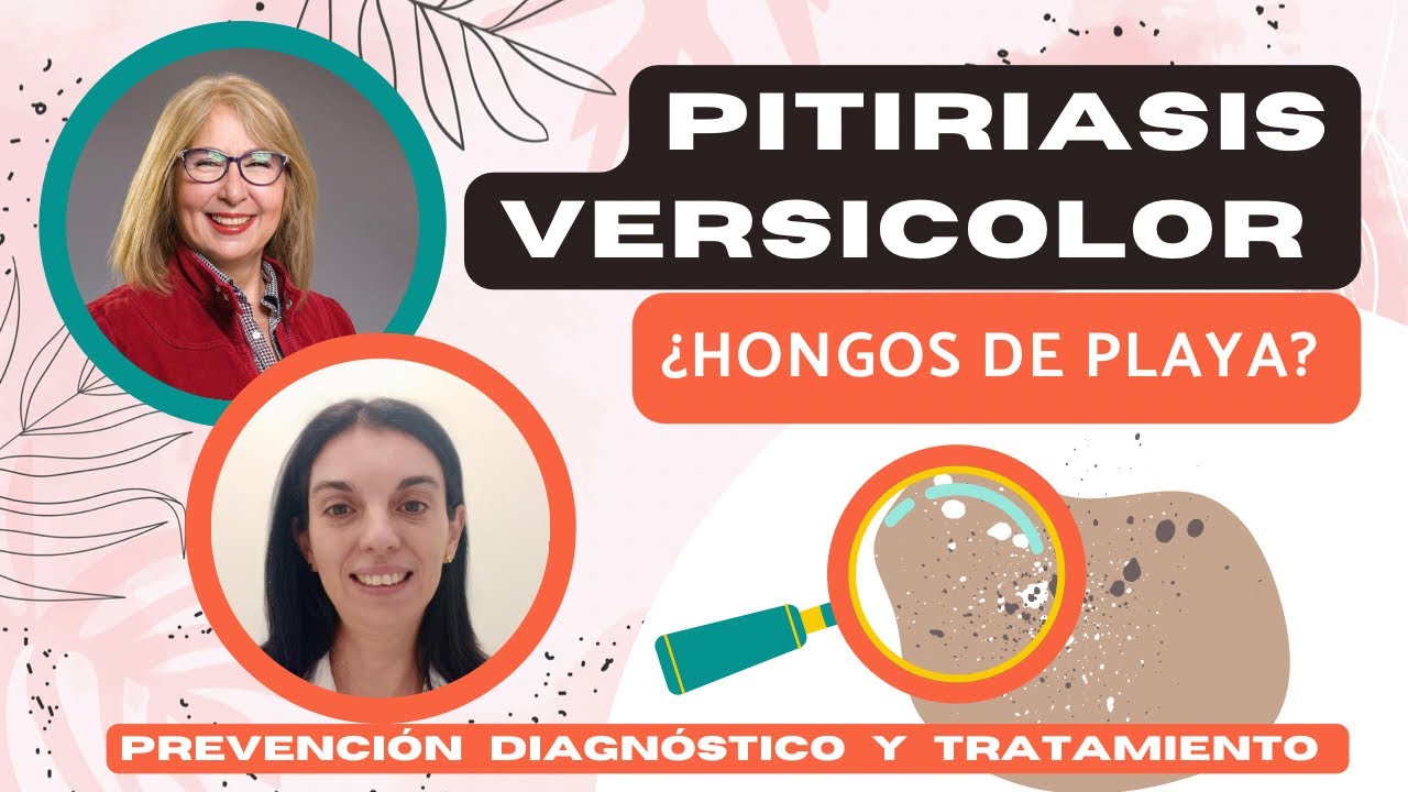 PITIRIASIS VERSICOLOR. ¿HONGOS DE PLAYA? ¿CÓMO SE CONTAGIAN ...