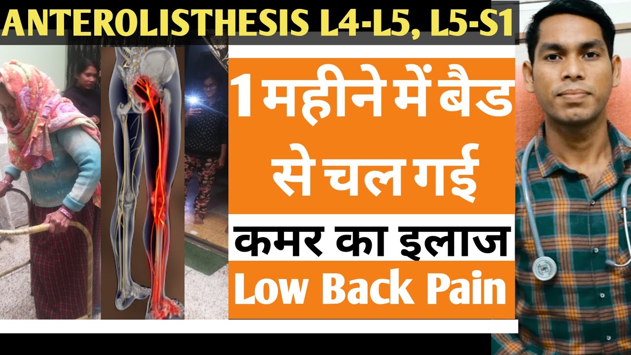 कमर दर्द, Lumbar Anterolisthesis, disc bulge, Herniation, T12-L1, L1-L2 ...