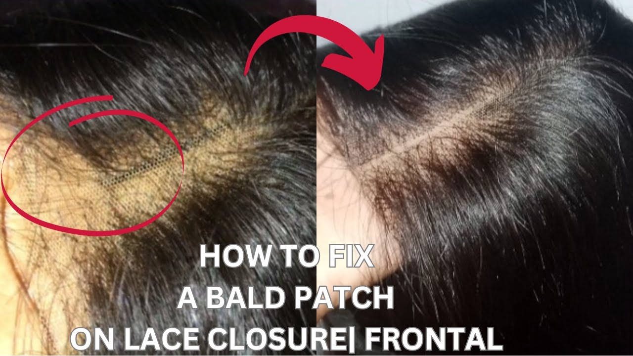 How To Fix Bald Patch On Lace Closure |Frontal #howto #diy #closure ...
