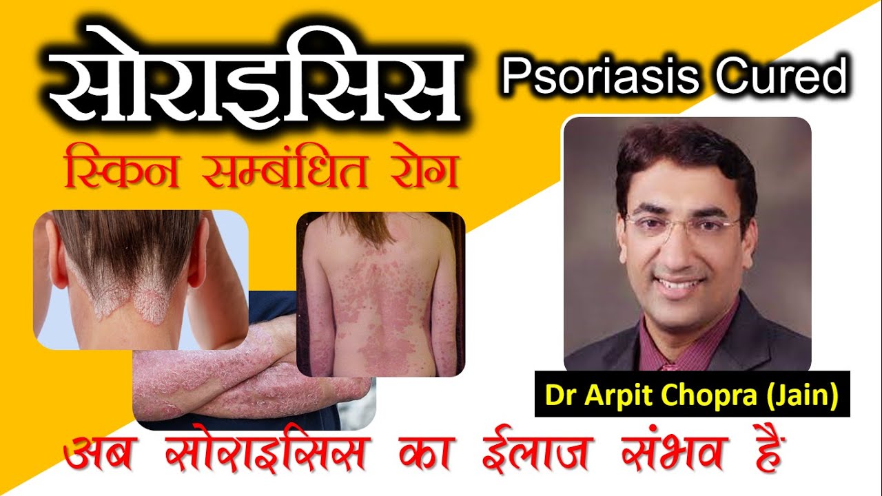 Psoriasis Permanent Treatment |Psoriasis Cure Success Story |Dr. Arpit ...