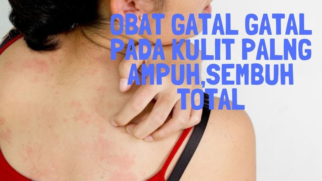 obat gatal gatal pada kulit palng ampuh,sembuh total” - YouTube