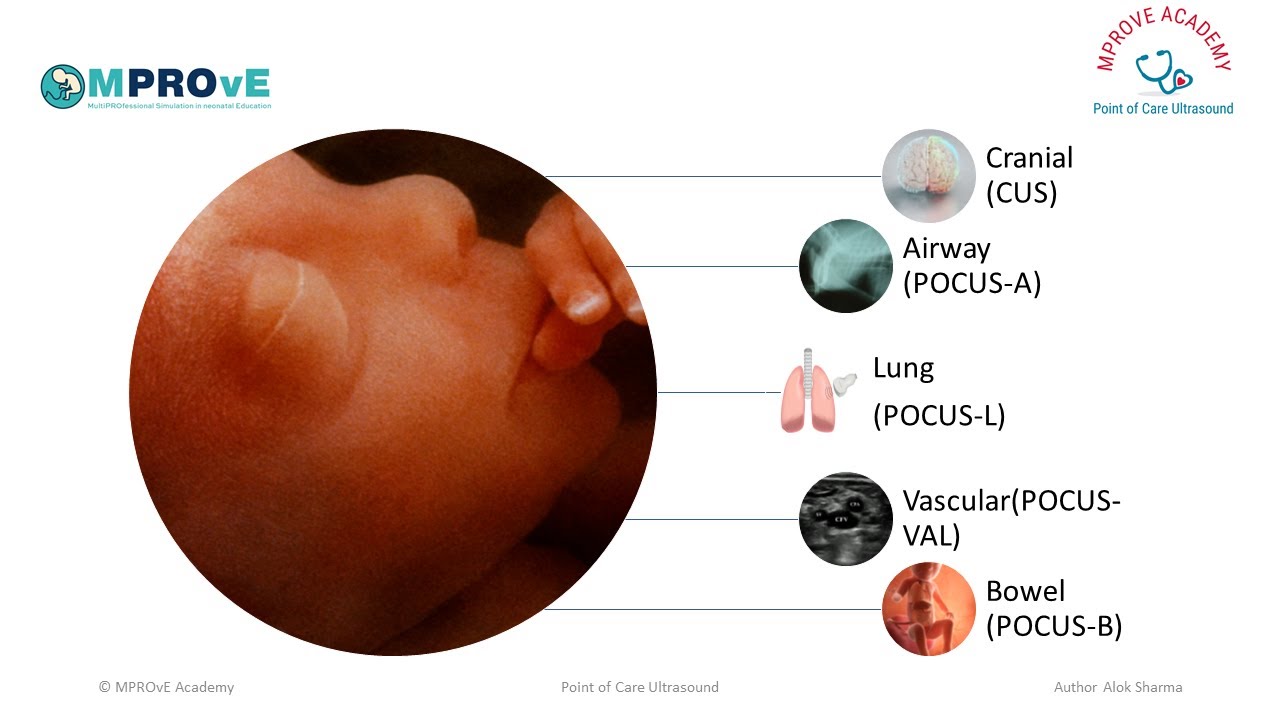 Session 16 Lung Ultrasound in Neonates -Diagnosis of Pneumonia Dr P ...