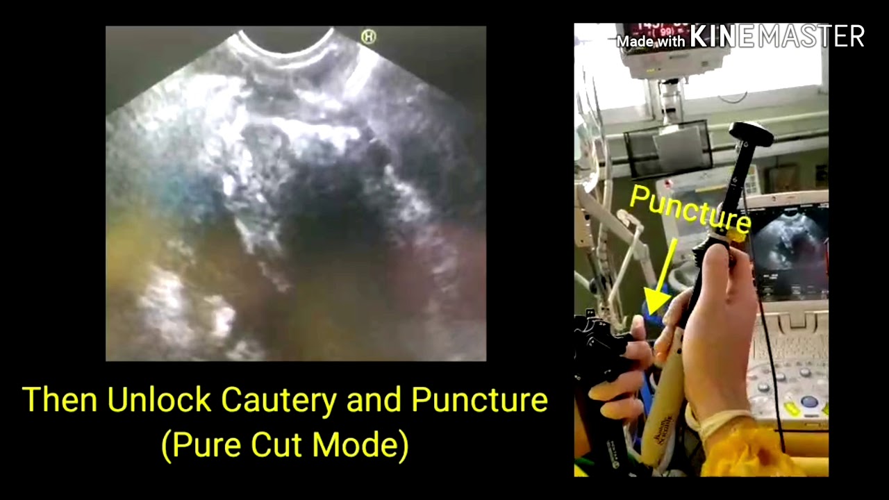 EUS : Hot Axios Step by Step - TWFC - YouTube