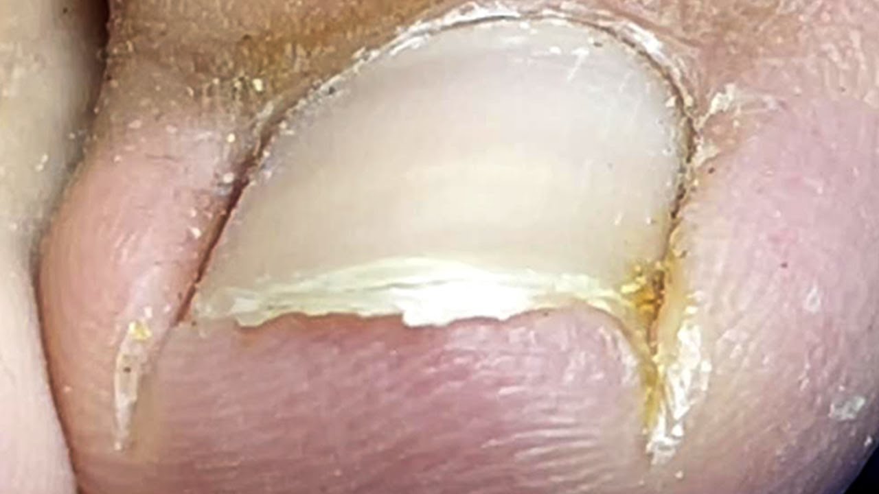 Two deep ingrown nails, carefully dug out - YouTube
